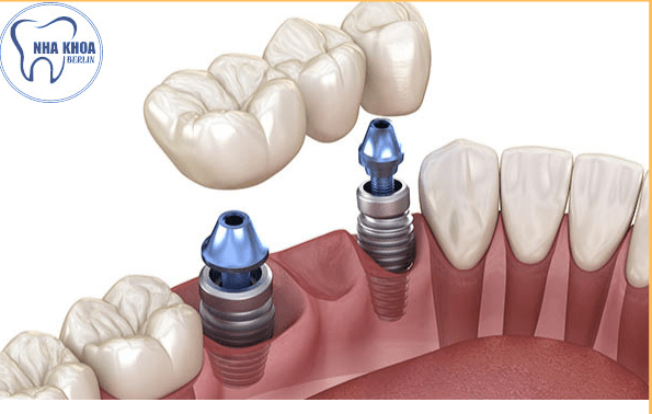 Phương pháp cầu răng sứ là gì? - Nha Khoa Berlin